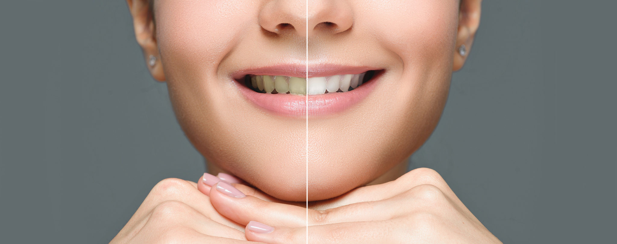 In Office Bleaching and Take Home Kits in Crespatown - https://www ...